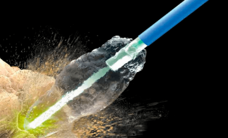 HoLEP: prostate laser surgery in Alicante
